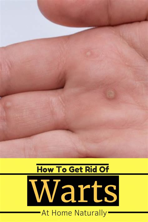 Remove Warts Artofit