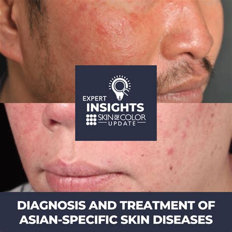 Diagnosis And Treatment Of Asian Specific Skin Diseases Next Steps In