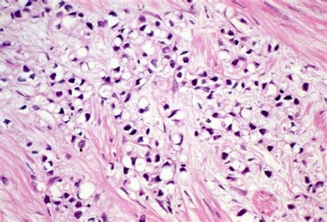 Signet Ring Like Cell Variant Diffuse Infiltration By Cords Of