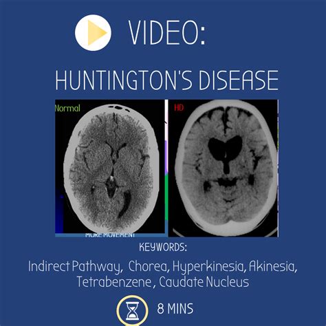Video Huntingtons Disease • Meducate