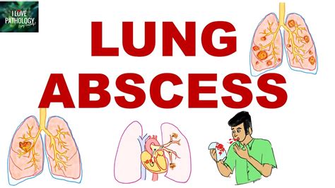 Lung Abscess Etiopathogenesis Morphology Clinical Features