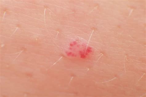 Traitement De Langiome à Paris Clinique Dermatologie Esthétique Skin Marceau