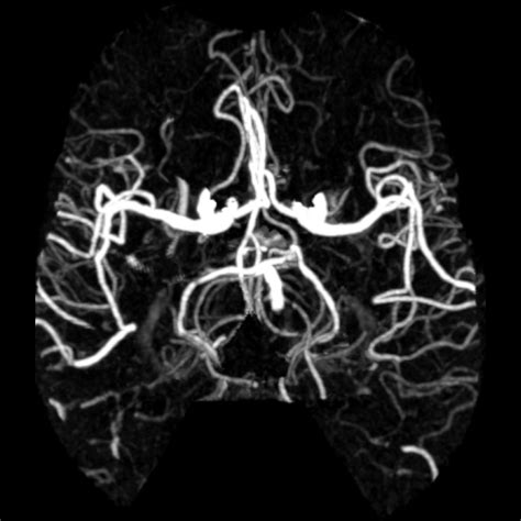 20 Hyperacute Stroke Decision Making For Clinicians Chss Elearning