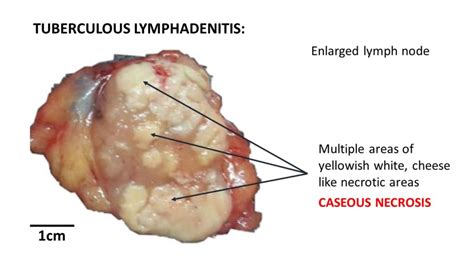 Tuberculous Lymphadenitis Pathology Made Simple