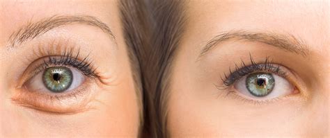 Does Botox Help With Eye Bags Truth And Alternatives For Puffy Eyes