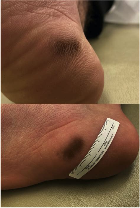 Pigmented Skin Lesion Without Biopsy Pigment The Journal Of Pediatrics