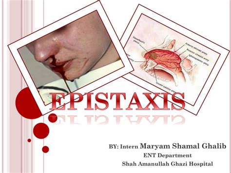 Epistaxis Pdf