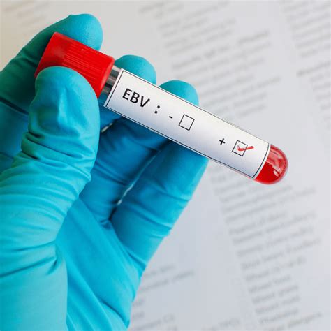 Antibody Blood Test For Glandular Fever At Karen Batey Blog