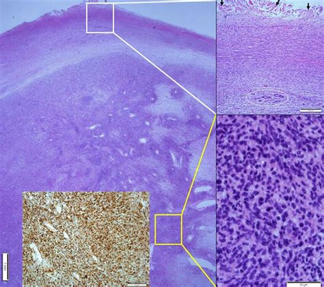 Histopathologic Findings Of Cutaneous Mpnst A Well Circumscribed
