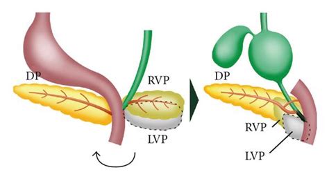 A Normal Development Of The Pancreas The Ventral Pancreatic Anlage