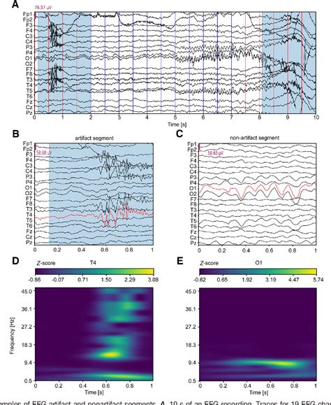 Figure From Improved Manual Annotation Of EEG Signals Through Convolutional Neural Network