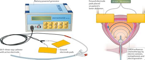 Electromotive Drug Administration Emda Mitomycin In Bladder Cancer