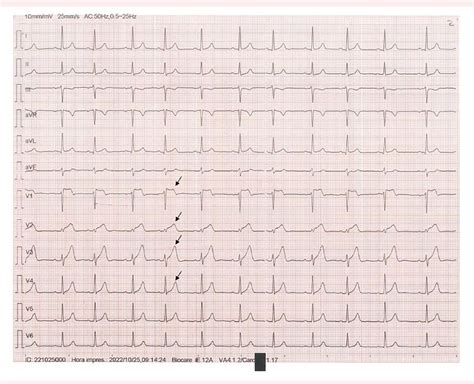 Figure 1 From An Uncommon Cause Of Anterior St Segment Elevation Semantic Scholar