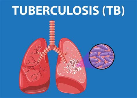 Tuberculosis Tbc Puskesmas Babakan Sari