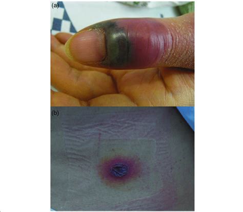 Cellulitis Thumb