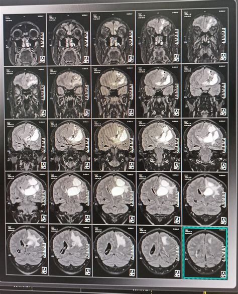 Mri Epilepsy Protocol Ct Scan And Mri