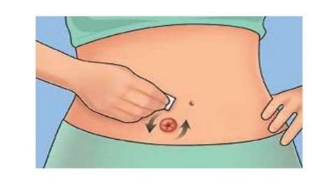 Colostomy Care Nursing Management Pdf