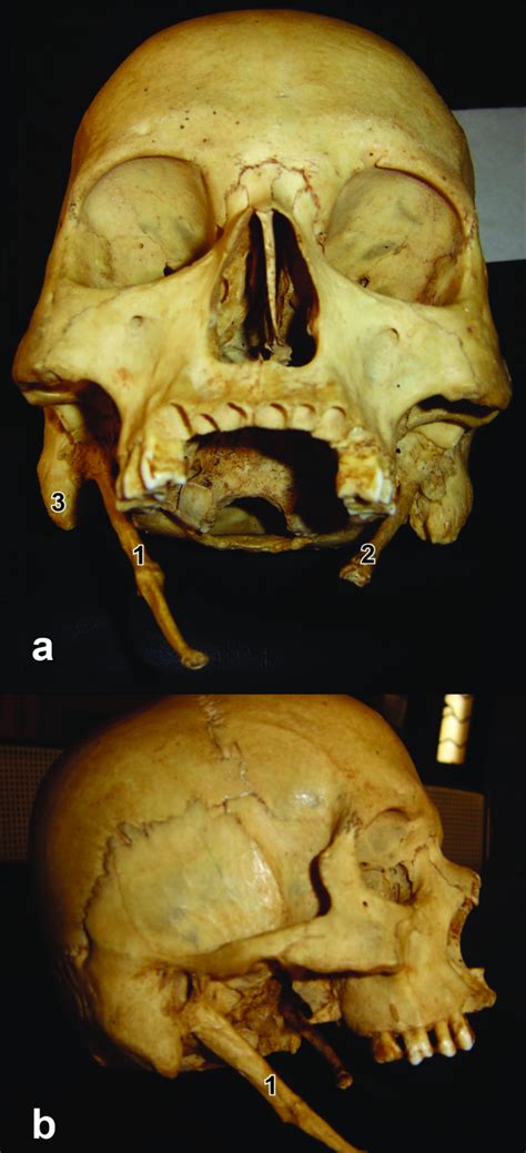 Figure114 A Frontal View Of Skull Showing Bilateral Elongated