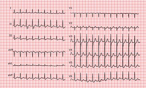 Cardio Fr Avnrt Nodal Reentry Tachycardia