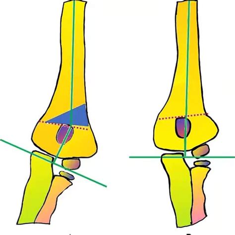 Schematic Diagram Of Cubitus Varus Deformity Correction The Green