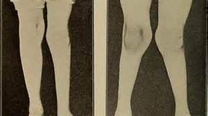 Improving Paediatric Bone Health Through Growth Modulation Everything You Need To Know About