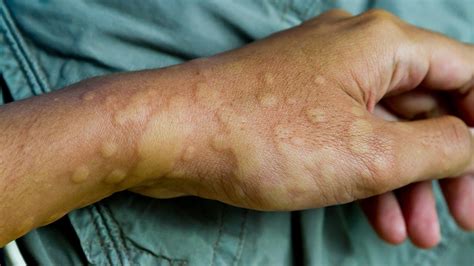 Itchy Palms Causes Symptoms Treatment And Prevention Dupuytren