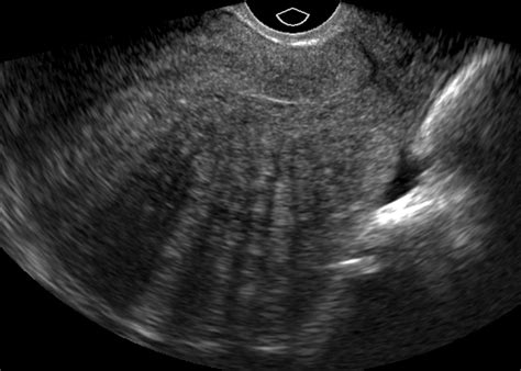 Adenomyosis A Sonographic Diagnosis Radiographics