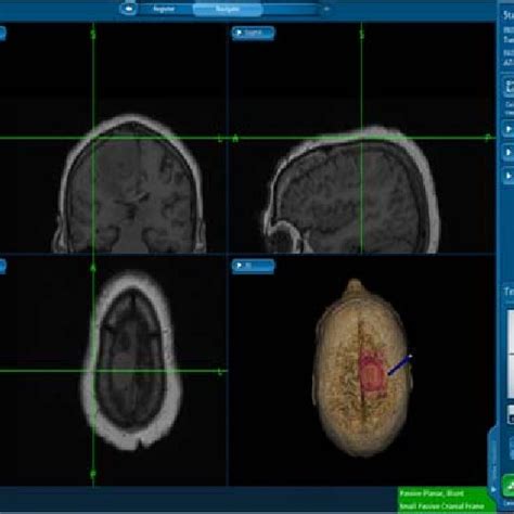C Intraoperative Neuronavigation With Stealth Station S7 Medtronic