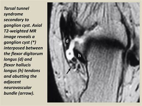 Presentation1 Radiological Imaging Of Tarsal Tunnel Syndrome Pptx