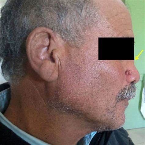 Pdf Recurrent Anterior Uveitis With Hypopyon Revealing Relapsing