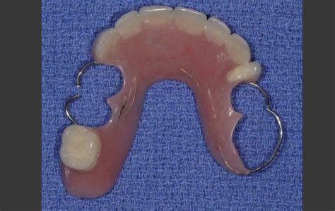 Front Partial Dentures
