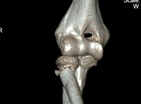 3d Ct Scan Right Elbow Coronoid Radial Neck Fracture R Radiology