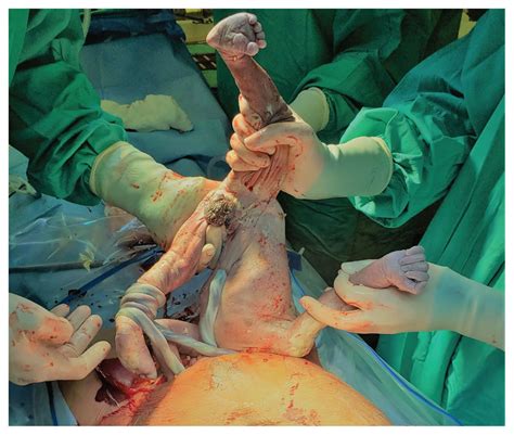 Footling Breech Presentation Malpresentation And Cord Prolapse
