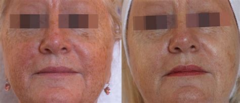 Before And After Photos Of Renouveau Med Spa Renouveau