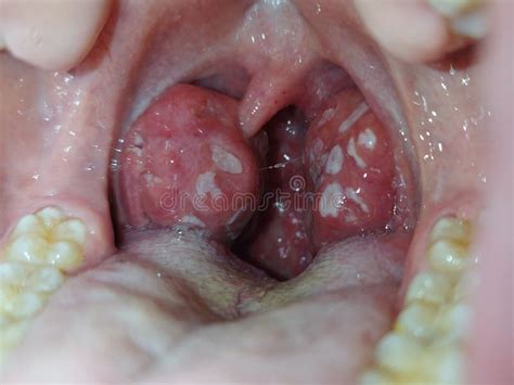 Bacterial Tonsillitis The Hidden Dangers Of Tonsillitis Why Timely