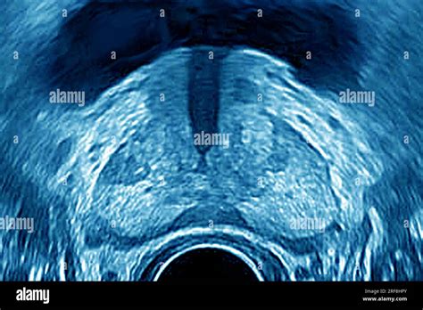Prostate Healthy Prostate Gland Visualized In Ultrasound In Frontal