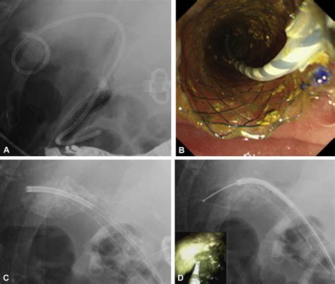 Transduodenal Necrosectomy For Acute Cholecystitis With The Use Of A