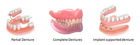 Fixed Or Removable Dentures ⭐️ Partial Or Complete Denture With Dental Implants