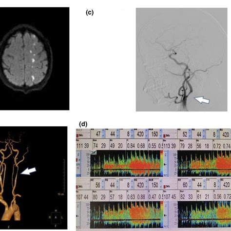 A In Patients With Ischemic Stroke Caused By Hypoperfusion There Was Download Scientific