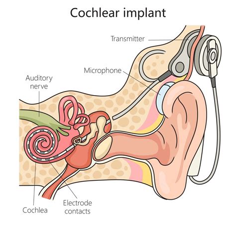 How Much Does A Cochlear Implant Surgery Cost In 2025
