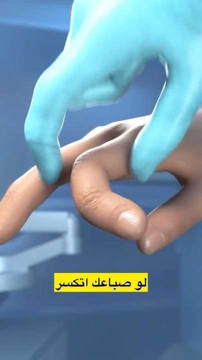 تتصرف ازاي لو صباع من ايدك اتكسر ؟🥺😳 Youtube