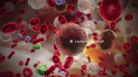 Overview Of Leukemia Blood Disorders Merck Manual Consumer Version