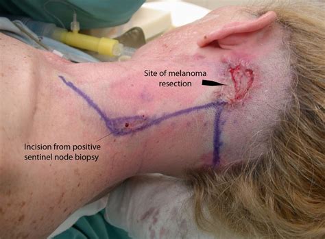 Posterolateral Neck Dissection Positioning And Surgical Steps Iowa