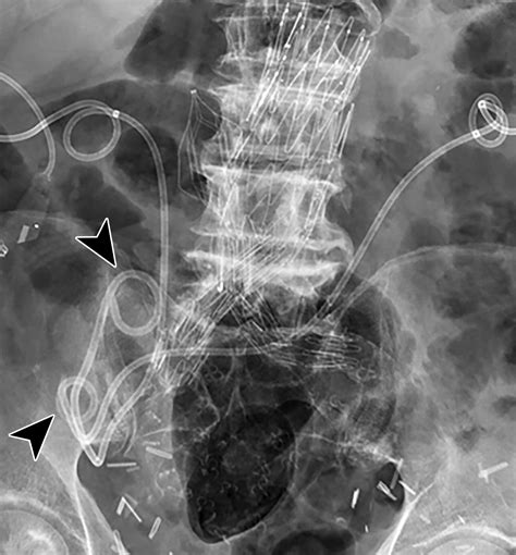 Complications Of Ileal Conduits After Radical Cystectomy Interventional Radiologic Management