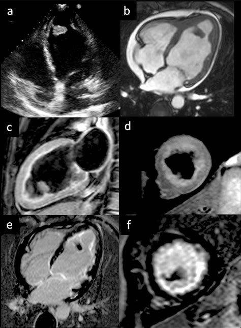 Endomyocardial Fibrosis 40 Year Old Patient With Hypereosinophilia