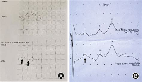 Baep Test A The Baep Results Of A Patient With Hearing Impairment On