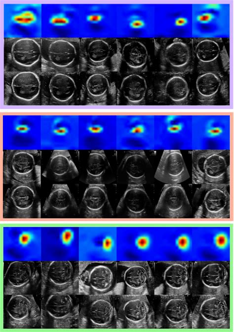 Figure 5 From Exploiting Class Activation Mappings As Prior To Generate Fetal Brain Ultrasound