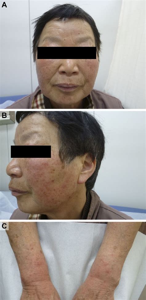 Figure1maculopapular Rash In A Patient On Ldvsof The Patient
