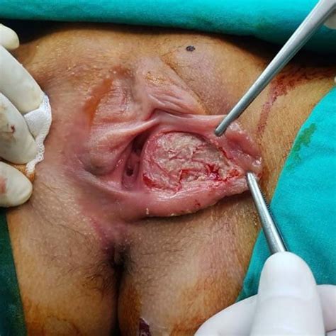 After Debrided In Operating Room Download Scientific Diagram