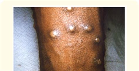 Maculopapular Lesions Over Forearm Download Scientific Diagram